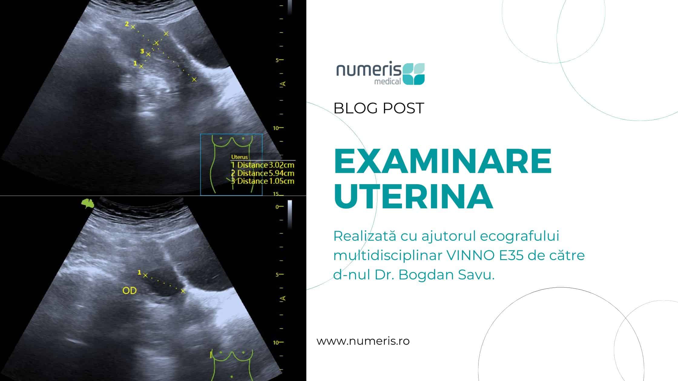 EXAMINARE ECOGRAFICA UTERINA - ECOGRAF VINNO E35
